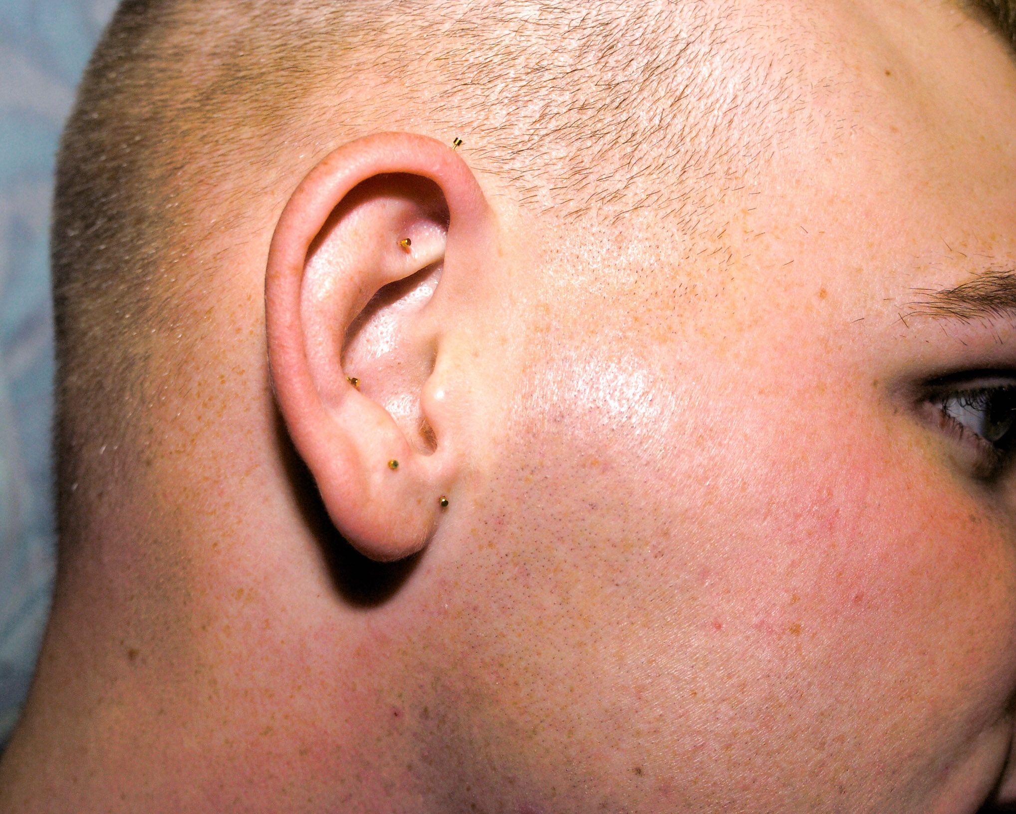 Battlefield acupuncture introduced at Landstuhl