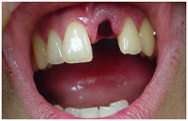 Dental damage after sports injury