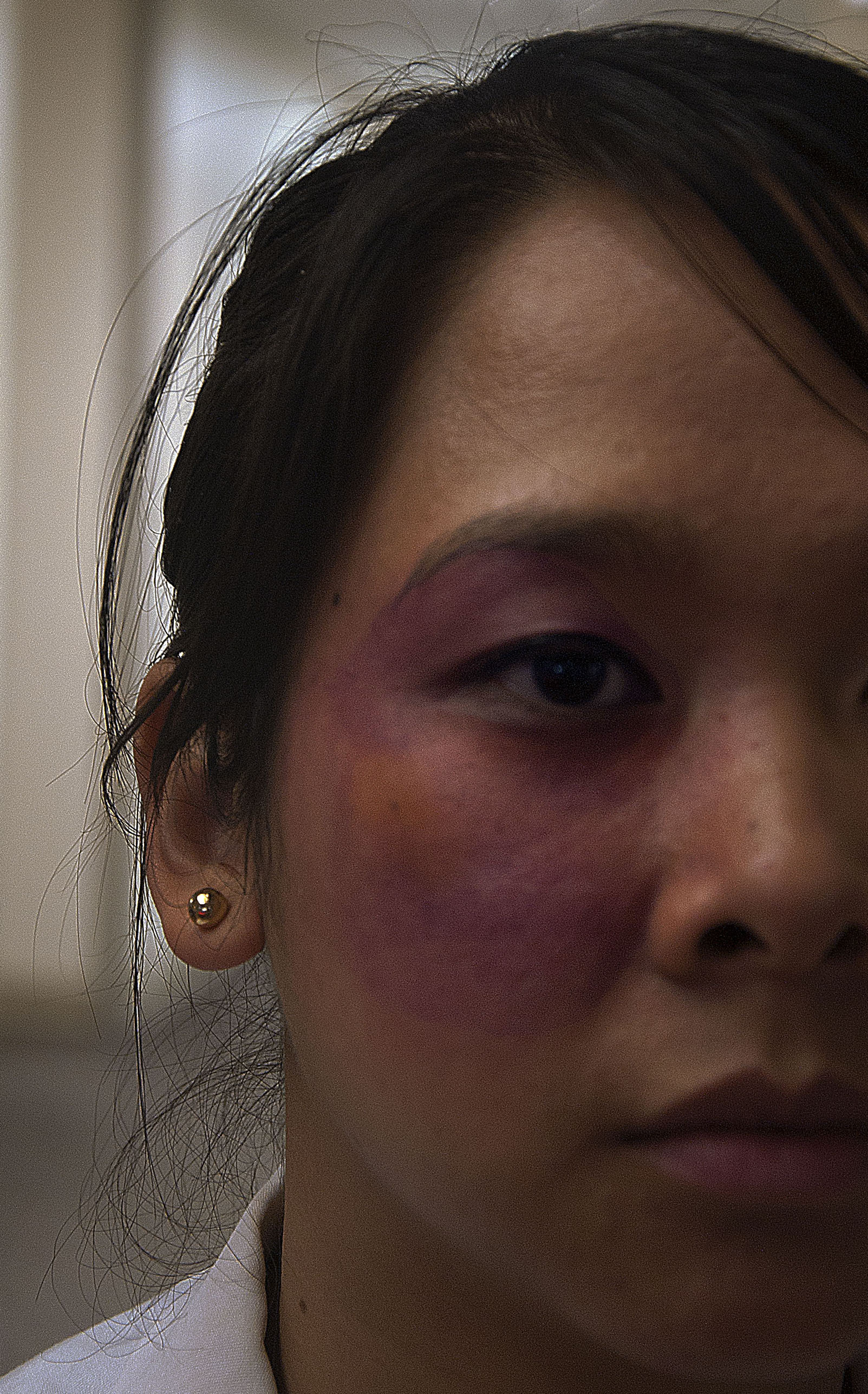 The Black Eye Campaign > Air Force Medical Service > Display