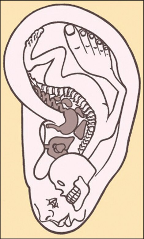 Battlefield acupuncture allows quicker recovery time > Peterson Space ...