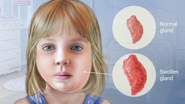 Mumps and You > Fairchild Air Force Base > Display