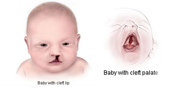 cleft palate forehead